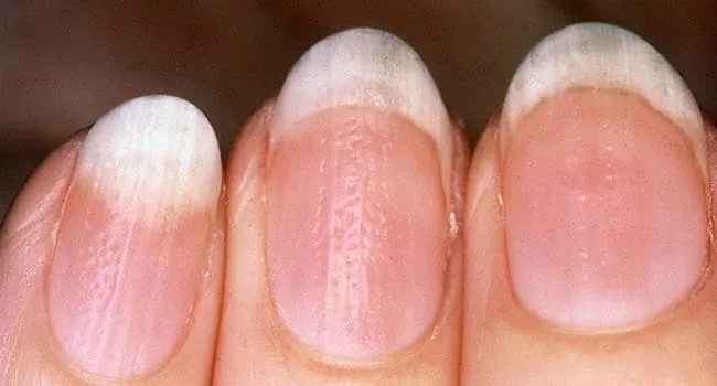 What Your Fingernails Say About Your Health: Ridges, Spots, Lines ...