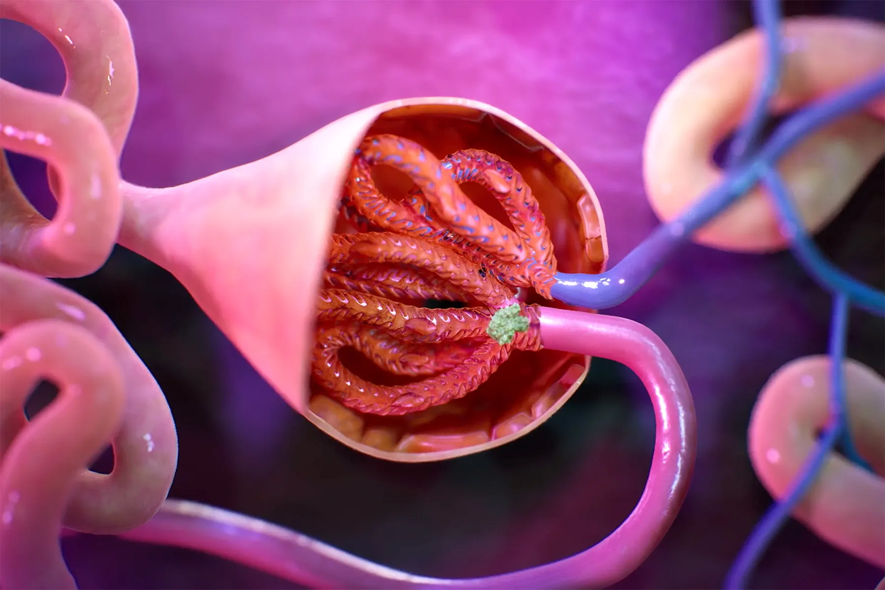 How Does Complement 3 Glomerulopathy Damage Your Kidneys?