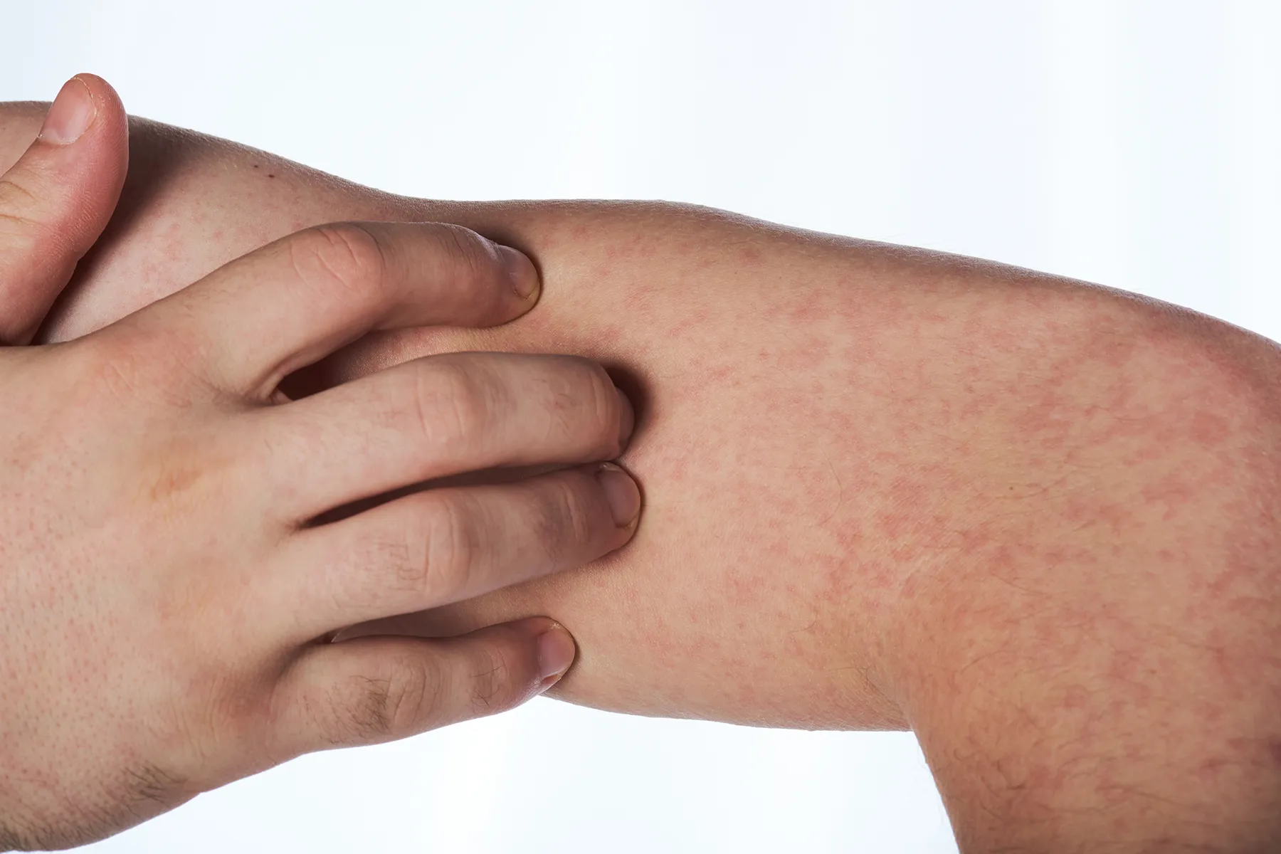 The Truth About Eczema