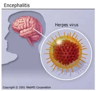 Encephalitis - Causes & Risk Factors
