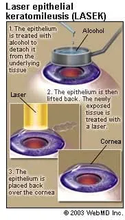 LASEK Laser Eye Surgery