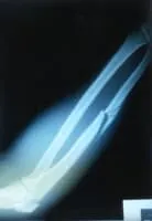 Broken Arm: Symptoms, Causes, Diagnosis, Treatment