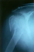 Broken Arm: Symptoms, Causes, Diagnosis, Treatment