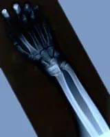 Broken Arm: Symptoms, Causes, Diagnosis, Treatment