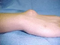 Ganglion Cyst: Symptoms, Causes, Diagnosis, and Treatment