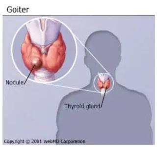 What Is a Goiter? What Causes Goiters?