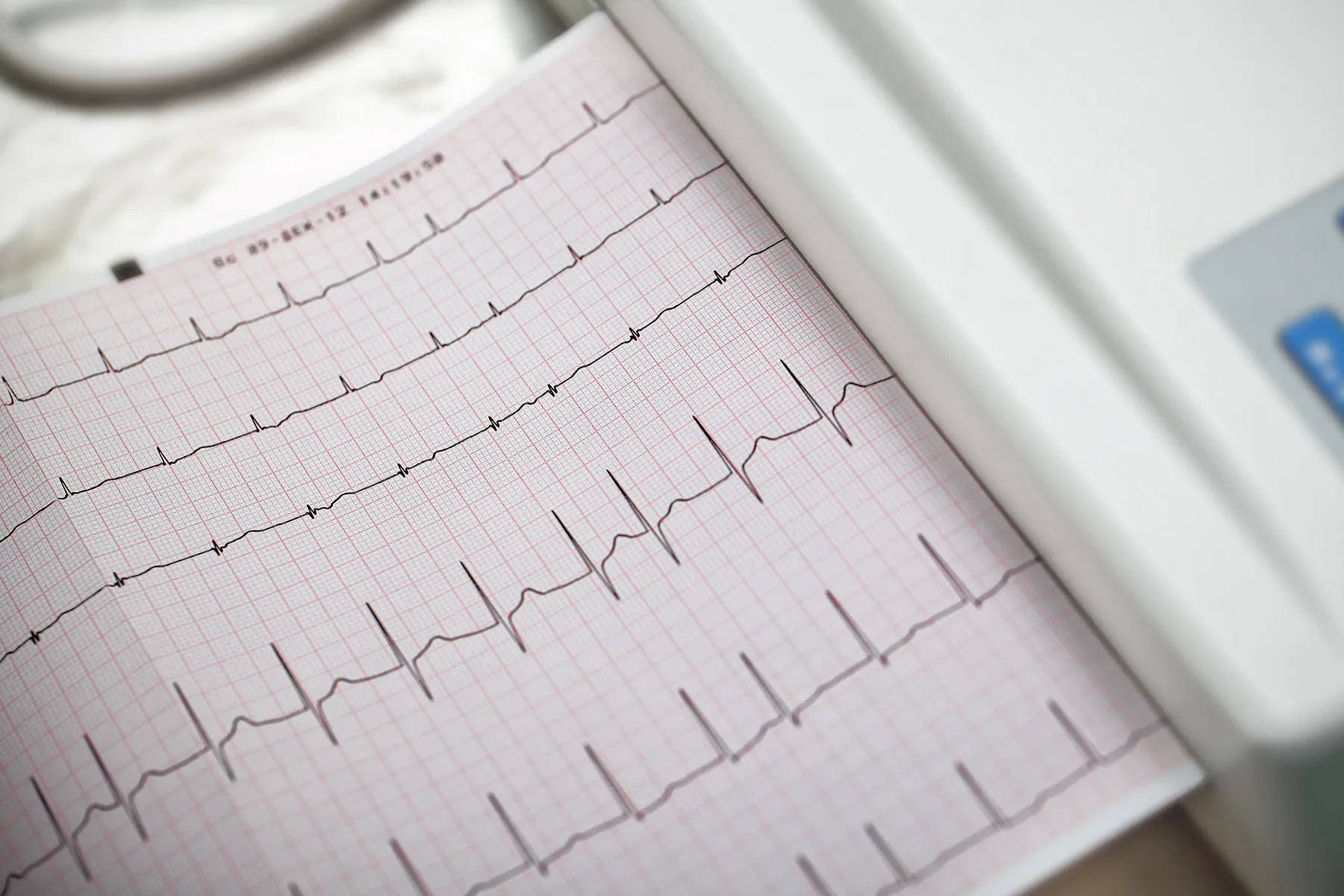 Normal Sinus Rhythm vs. Atrial Fibrillation Irregularities
