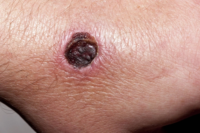 Bug Bites Pictures: Identifying Bugs and Bug Bites