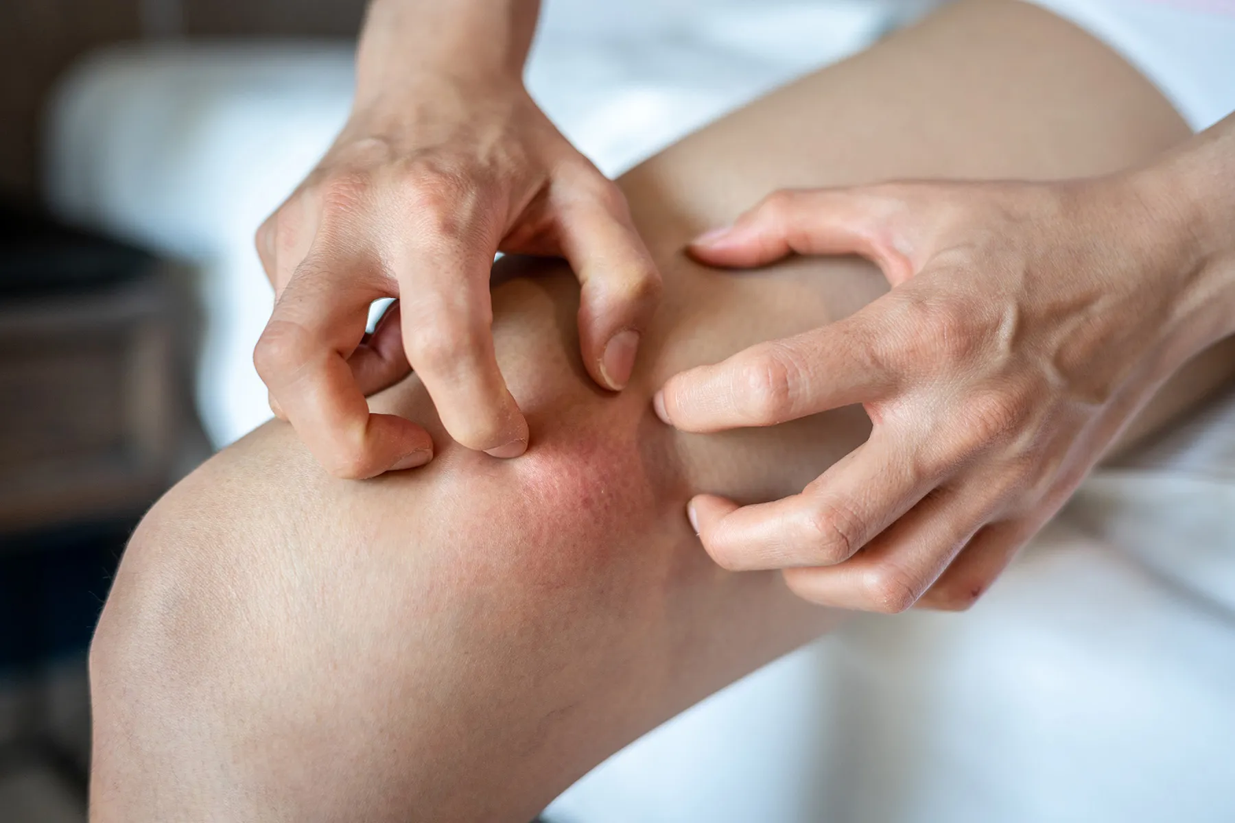 Eczema And Inflammation