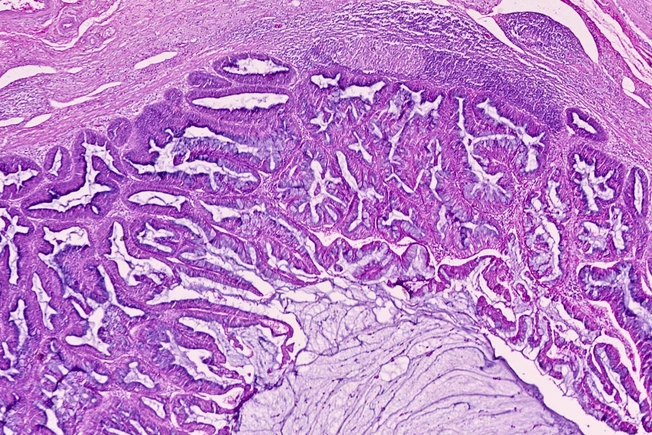 Visual Guide to Appendix Cancer