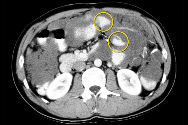 Visual Guide to Appendix Cancer