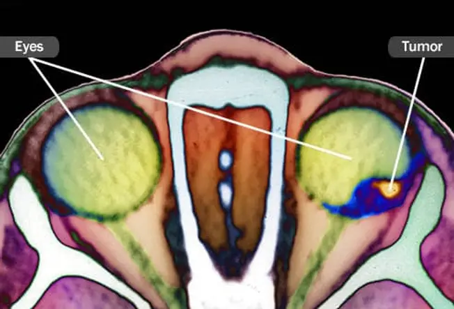 Visual Guide to Eye Cancers