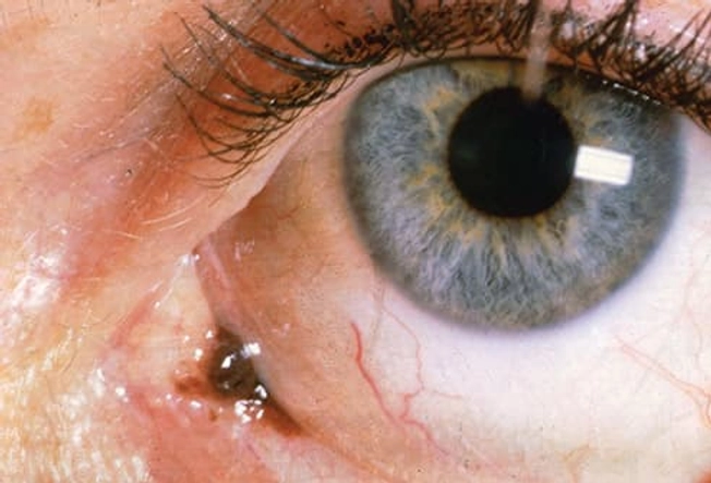 Visual Guide to Eye Cancers