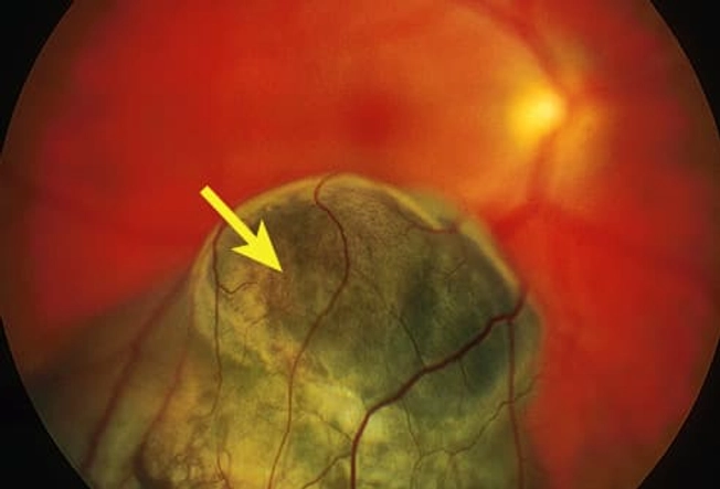 Visual Guide to Eye Cancers