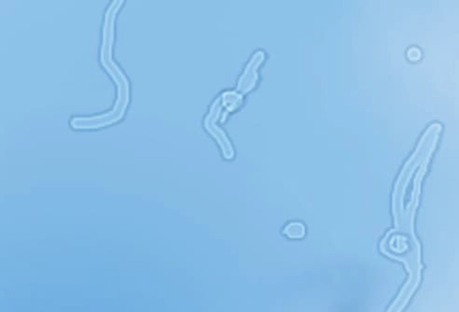 Visual Guide to Eye Cancers