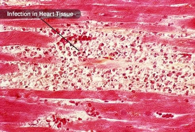 How Heart Disease Affects Your Body