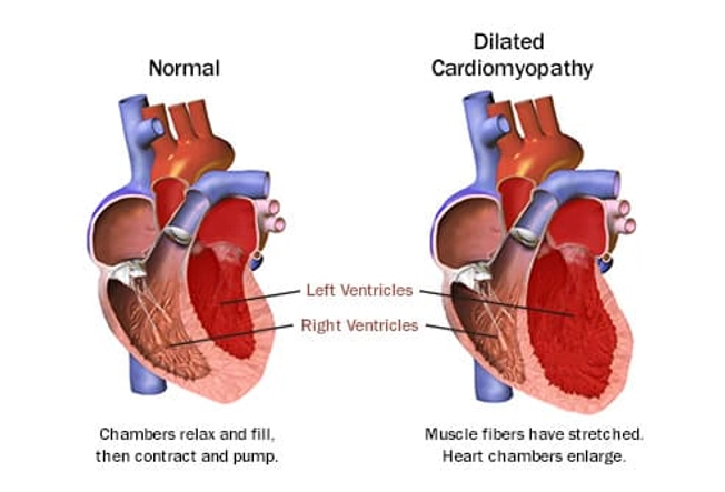 How Heart Disease Affects Your Body