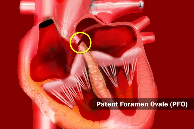 How Migraines Increase Risks for Health Conditions