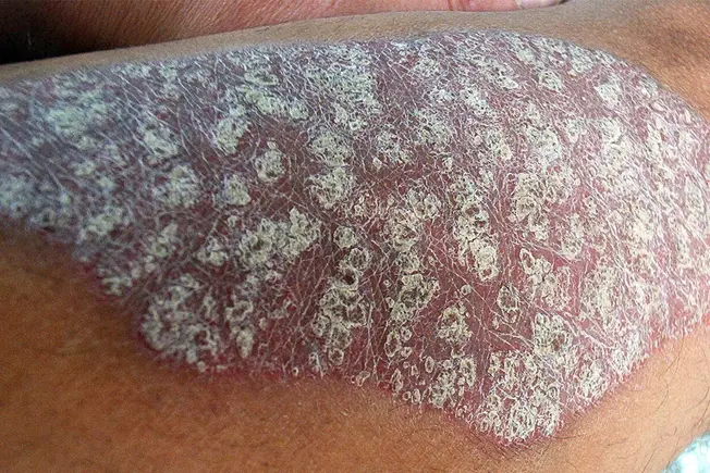 Non-Contagious Skin Conditions: Bumps, Rashes, Moles and More