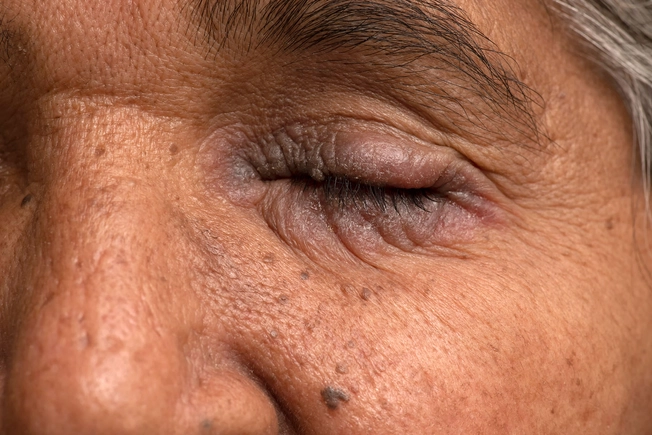 Non-Contagious Skin Conditions: Bumps, Rashes, Moles and More