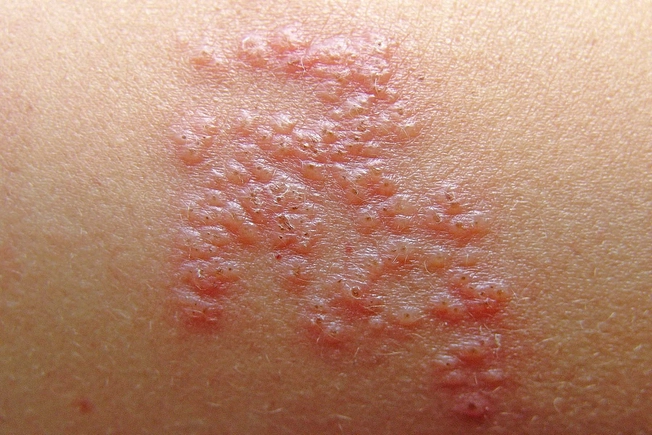 Non-Contagious Skin Conditions: Bumps, Rashes, Moles and More