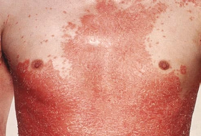 Pictures of Plaque Psoriasis, Pustular Psoriasis, and Other Types of ...