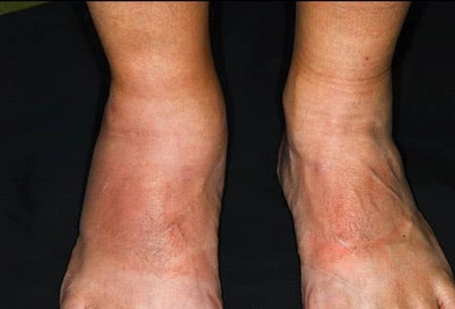 Pictures Of Plaque Psoriasis Pustular Psoriasis And Other Types Of Psoriasis