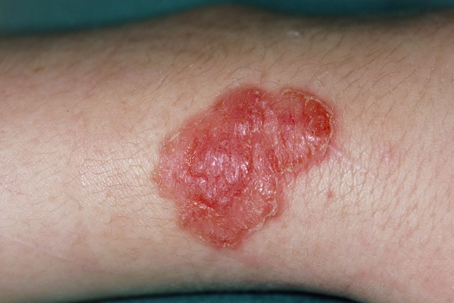 Scabies: Pictures of Rash & Mites, Symptoms, Treatment