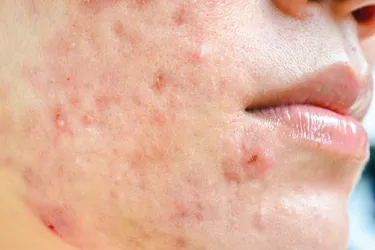 Acne in Men: Causes and Treatments