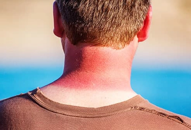 14 Summer Health Hazards to Avoid