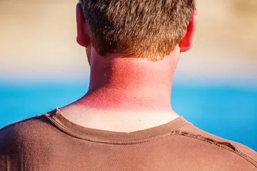 Sunburn Prevention and Treatment