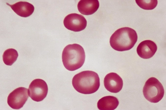 Symptoms of Mycobacterium Avium Complex (MAC)