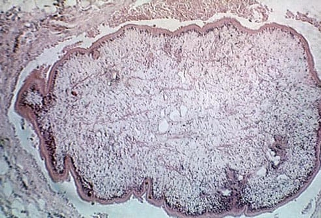 Bugs That Burrow Under Skin