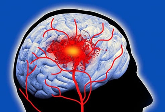 15 Types of Thrombosis Explained With Illustrations