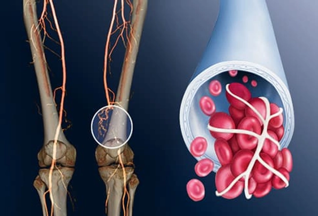 15 Types of Thrombosis Explained With Illustrations