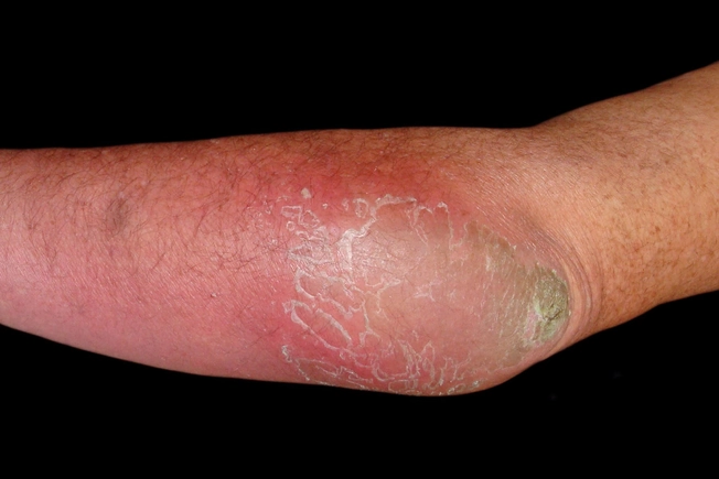 Visual Guide to Bursitis