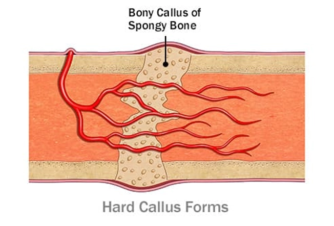 Broken Bone Pictures: Signs Your Broken Bone Is Healing
