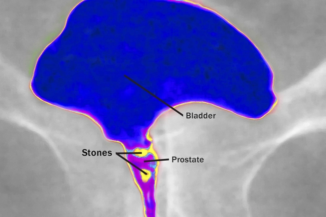 Where Stones Can Form in Your Body