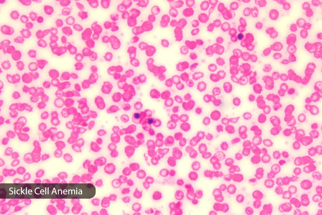 Pictures of Reasons You Have Chills Other Than Fever