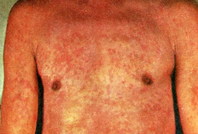 Pictures of Blotchy Skin: Rosacea, Hives, Psoriasis, and More