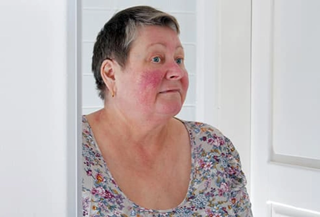 Pictures of Blotchy Skin: Rosacea, Hives, Psoriasis, and More