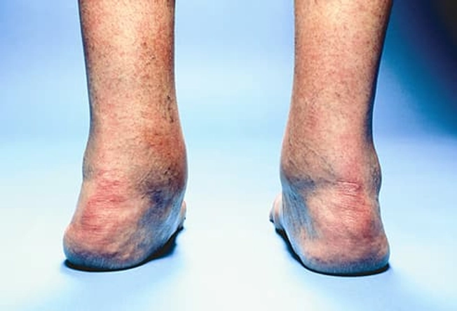 Why Does My Ankle Hurt? 15 Possible Causes of Ankle Pain