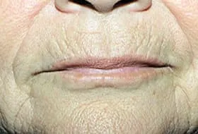 Get the Truth About Reversing Wrinkles - Watch WebMD Video