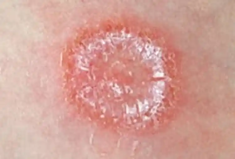 Athlete's Foot & Ringworm Facts - Watch WebMD Video