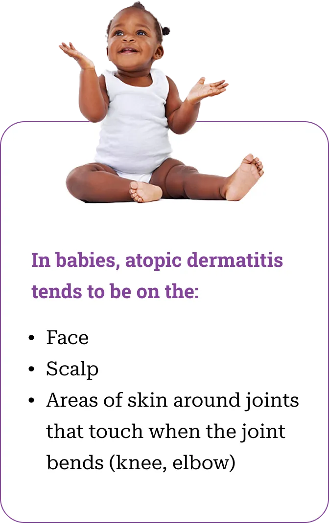 Children and Atopic Dermatitis: What You Need to Know